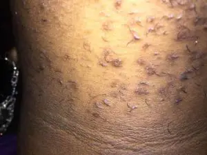 Ingrown Hair on Neckline, Back of Neck, Female, How to get rid, Treat ...
