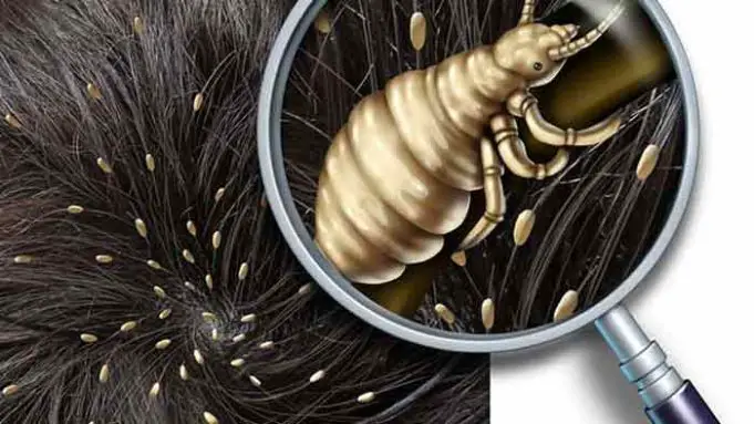 How to Check Yourself for Lice-how to tell if you have Lice by Yourself ...