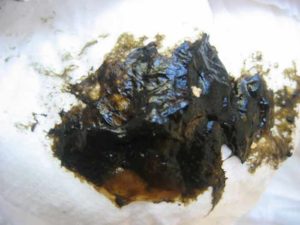 Black Tarry Stool Causes, Indications & Symptoms | CureHows