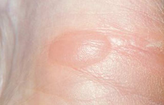 Lady Blisters-All you Need to Know | CureHows